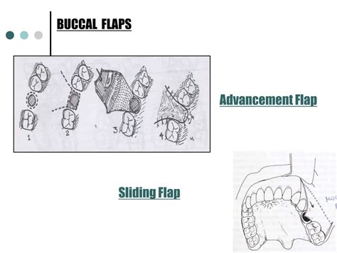17 Maxillary Sinus Antrum Of Highmore Surgical Anatomy Pptx
