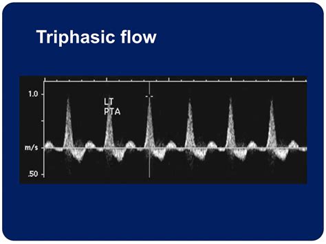 Chronic Limb Threatening Ischemia Pvdpptx