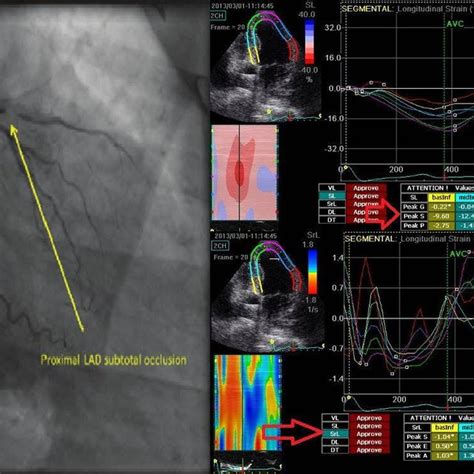 Segmental Longitudinal Strain And Strain Rate In Patient With Subtotal Download Scientific