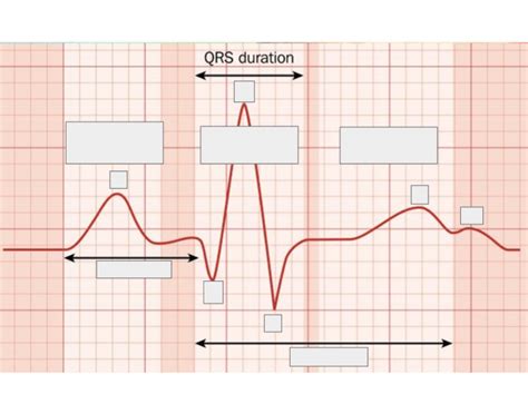 Ecg 2 Quiz
