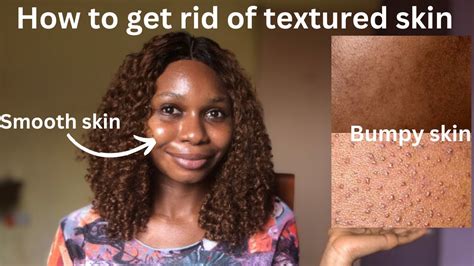 How To Get Rid Of Textured And Bumpy Skin At Hunter Lilley Blog