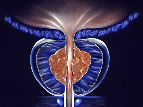 Rezum Treatment For Bph In Turkey At The Best Price
