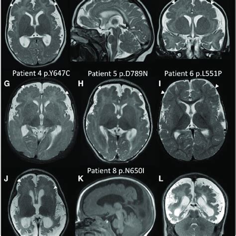Polymicrogyria In Patients With Grin1 Mutations Axial Midline Download Scientific Diagram