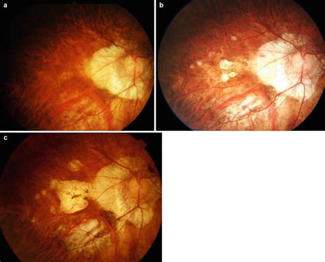 Myopic Chorioretinal Atrophy Springerlink