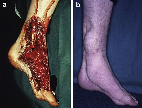 Degloved Foot