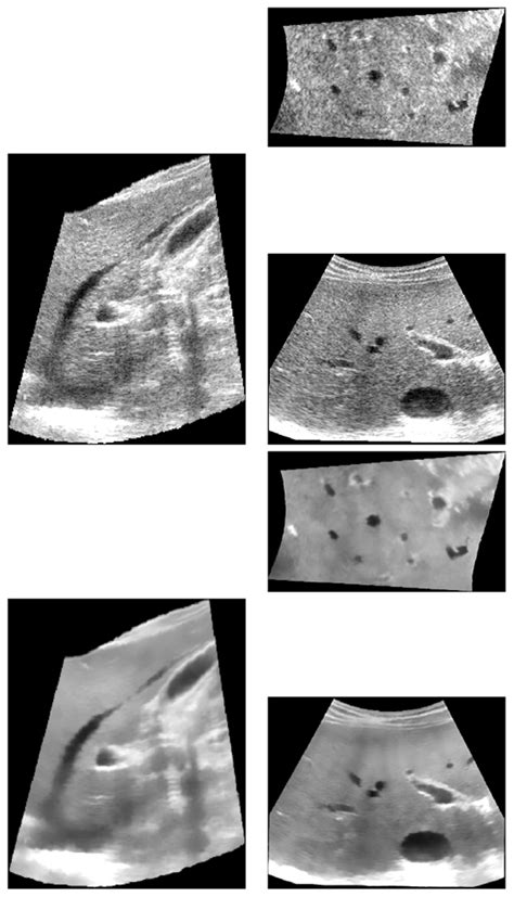 Nonlocal Means Based Speckle Filtering For Ultrasound Images