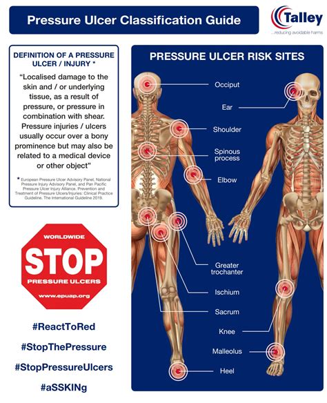 Our Pressure Ulcer Classification Guide Talley Group Ltd