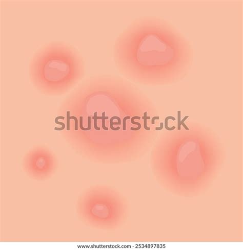 Understanding Type Acne Comprehensive Visual Guide Stock Vector Royalty Free 2534897835