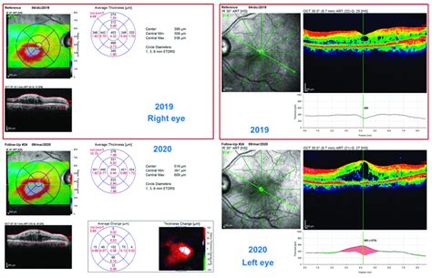 Spectral Domain Optical Coherence Tomography Sd Oct Of A Diabetic Download Scientific Diagram