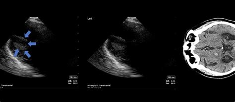 Brain Topography On Adult Ultrasound Images Techniques Interpretation