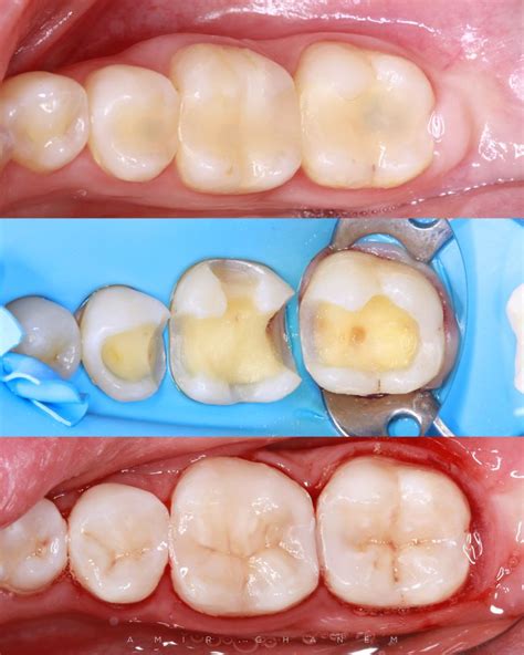 Amir Ghanem On Linkedin Biomimetic Composite Compositerestoration