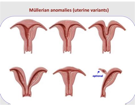 Mullerian Anomalies Quiz