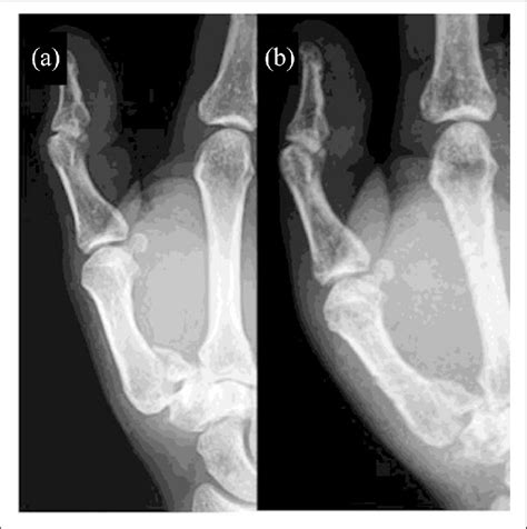 Displaced Large Fragment Fracture A Treated With Crpp With Final Download Scientific Diagram