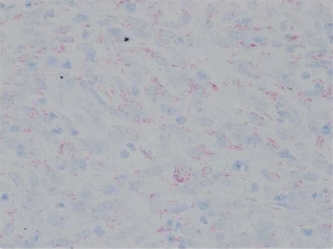 Mycobacterial Spindle Cell Pseudotumor Abstract Europe Pmc