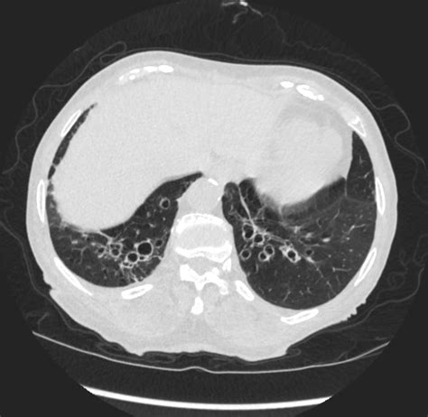 154lu Bronchiectasis The Common Vein
