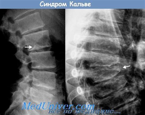 Синдром Кальве (Calve) - синонимы, авторы, клиника