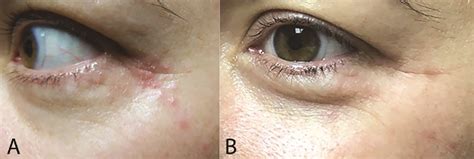 Figure 1 From Case Of Angular Blepharitis Caused By Demodex