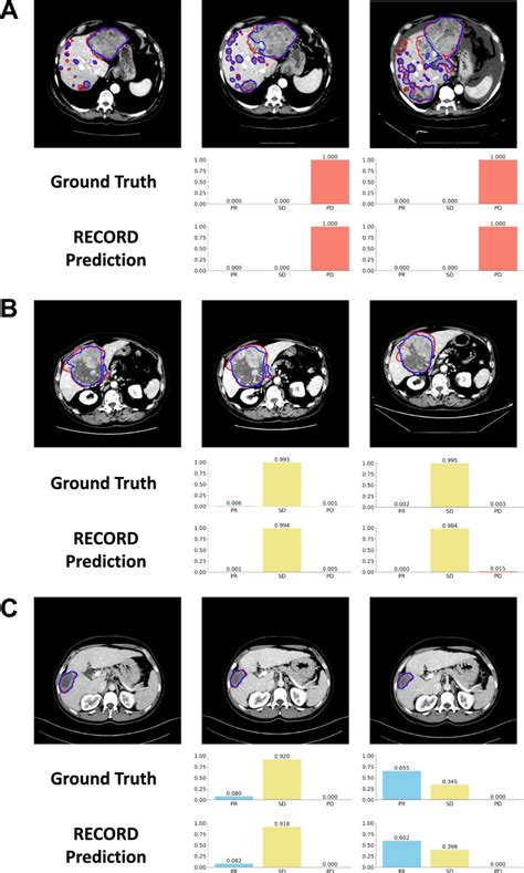 Deep Learning For Oncologic Treatment Outcomes And Endpoints Evaluation From Ct Scans In Liver