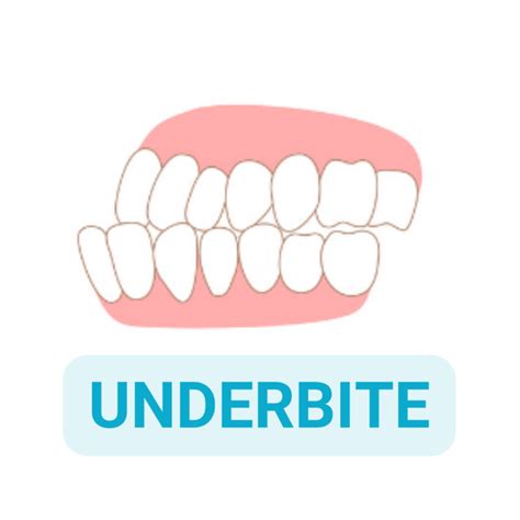 Underbite Vs Overbite And What You Should Know About Treatments