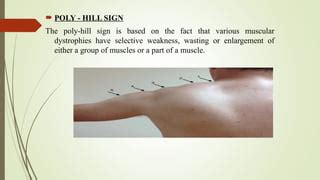 Musculo Skeletal Disorders Part Ii Ppt Ppt