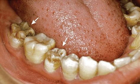 Abnormal Tooth Morphology Pocket Dentistry