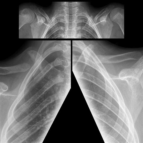 Pseudoarthrosis Of Clavicle Pediatric Radiology Reference Article Pediatric Imaging