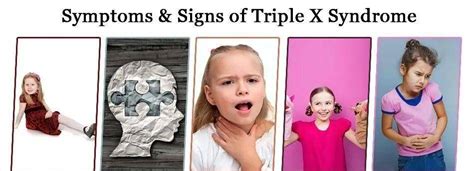 Xxx综合征 一种很“女人的”遗传病染色体患者女性