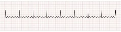 Ekg Monitor Showing Atrial Flutter 42268648 Vector Art At Vecteezy
