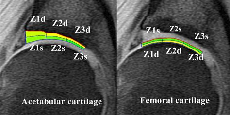Loaded Cartilage T2 Mapping In Patients With Hip Dysplasiaradiology