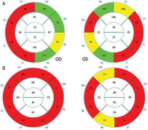 Genetic Testing For Wolfram Syndrome Mutations In A Sample Of 71 Patients With Hereditary Optic