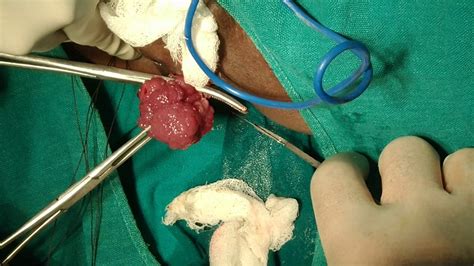 Excision Of A Polyp Captions Fortify