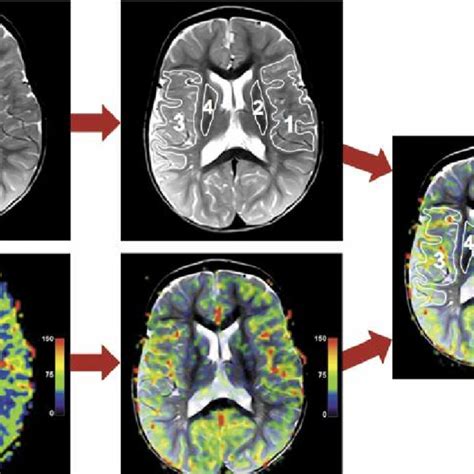 Pulsed Arterial Spin Labeling Image Superimposed With T2 Weighted