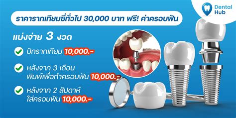 รากฟันเทียม โปรโมชั่นพิเศษ Dentalhubclinic