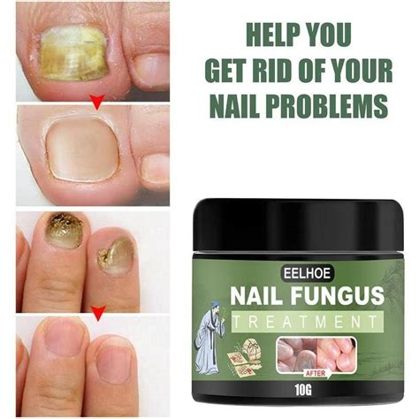 Ungüento Para El Tratamiento De Hongos En Las Uñas Crema