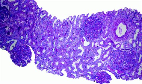 Endocarditis Associated Glomerulonephritis Abdominal Key