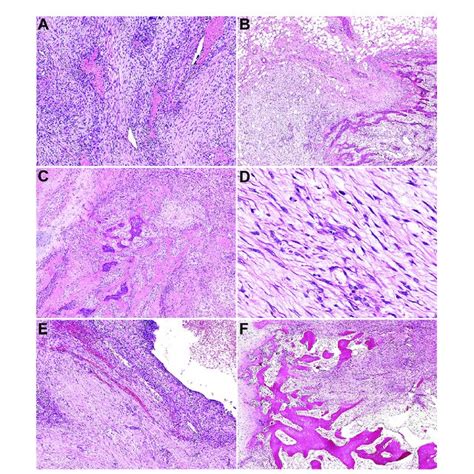 Histopathologic Characteristics Of Myositis Ossificans And