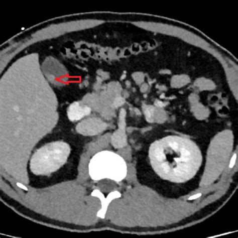 Ct Thorax Shows 10 Mm Nodule Along The Lateral Wall Of The Right Atrium Download Scientific