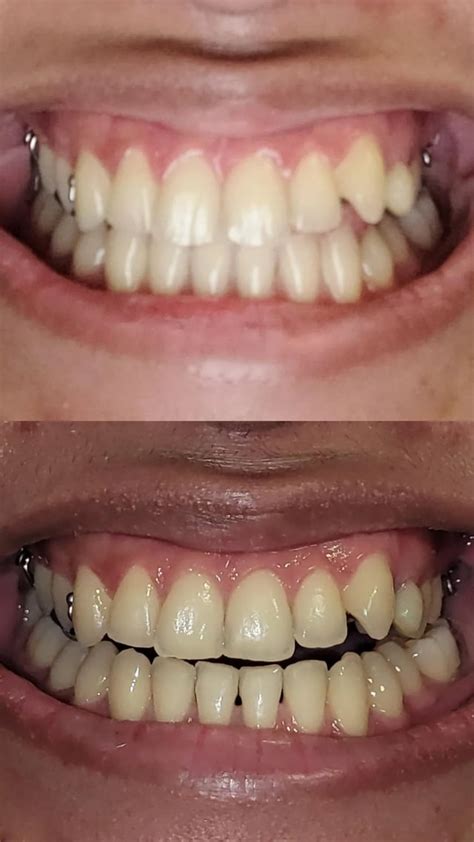 2 Months In With Removable Rpe R Braces