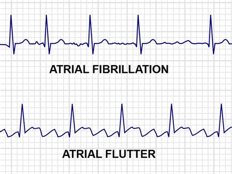 Atrial Flutter