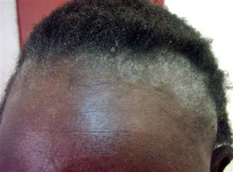 Seborrheic Dermatitis Hair Mild Javsystema