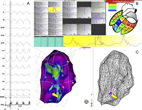 Localization Of Ventricular Tachycardia Patient 2 Download Scientific Diagram