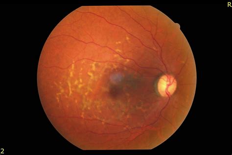 Multifocal Pattern Dystrophy