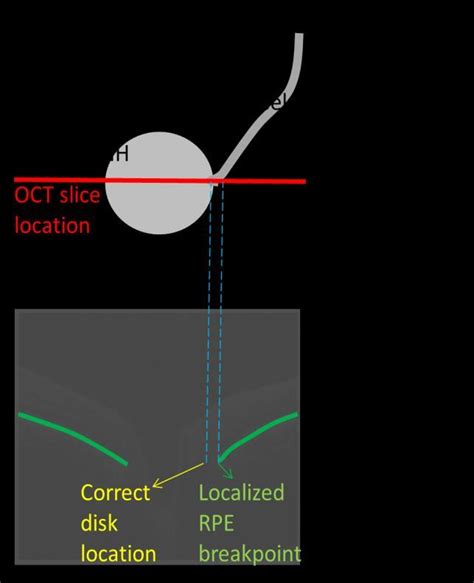 Improvement Of Rpe Localization By Vessel Information Iii Results To Download Scientific