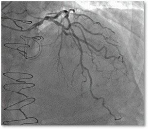 Multi Vessel Disease Boston Scientific
