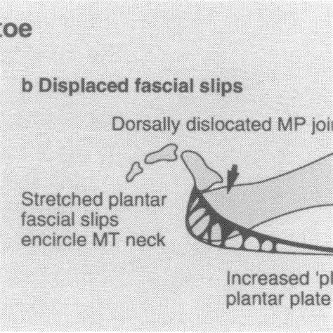 A Dorsiflexion Of The Big Toe And The Windlass Effect Of The Plantar