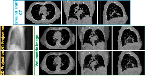 Real Time Tumor Tracking During Radiotherapy Emory School Of Medicine