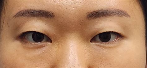 쌍커풀 수술자연유착 매몰 눈매교정 후기 리얼후기 눈이 예쁘다그래서 아몬드성형외과