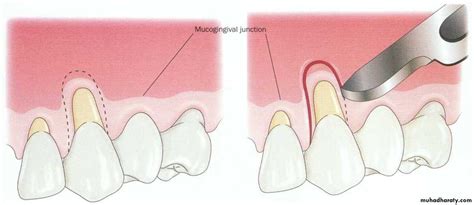 Mucogingival Problems