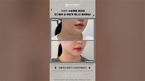 이중턱 근육묶기와 근육하 지방제거로 확실한 변화🌟 Youtube