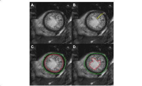Cmr Diagnostic Criteria For Lvnc A Cmr Short Axis Cine Bssfp Image Of